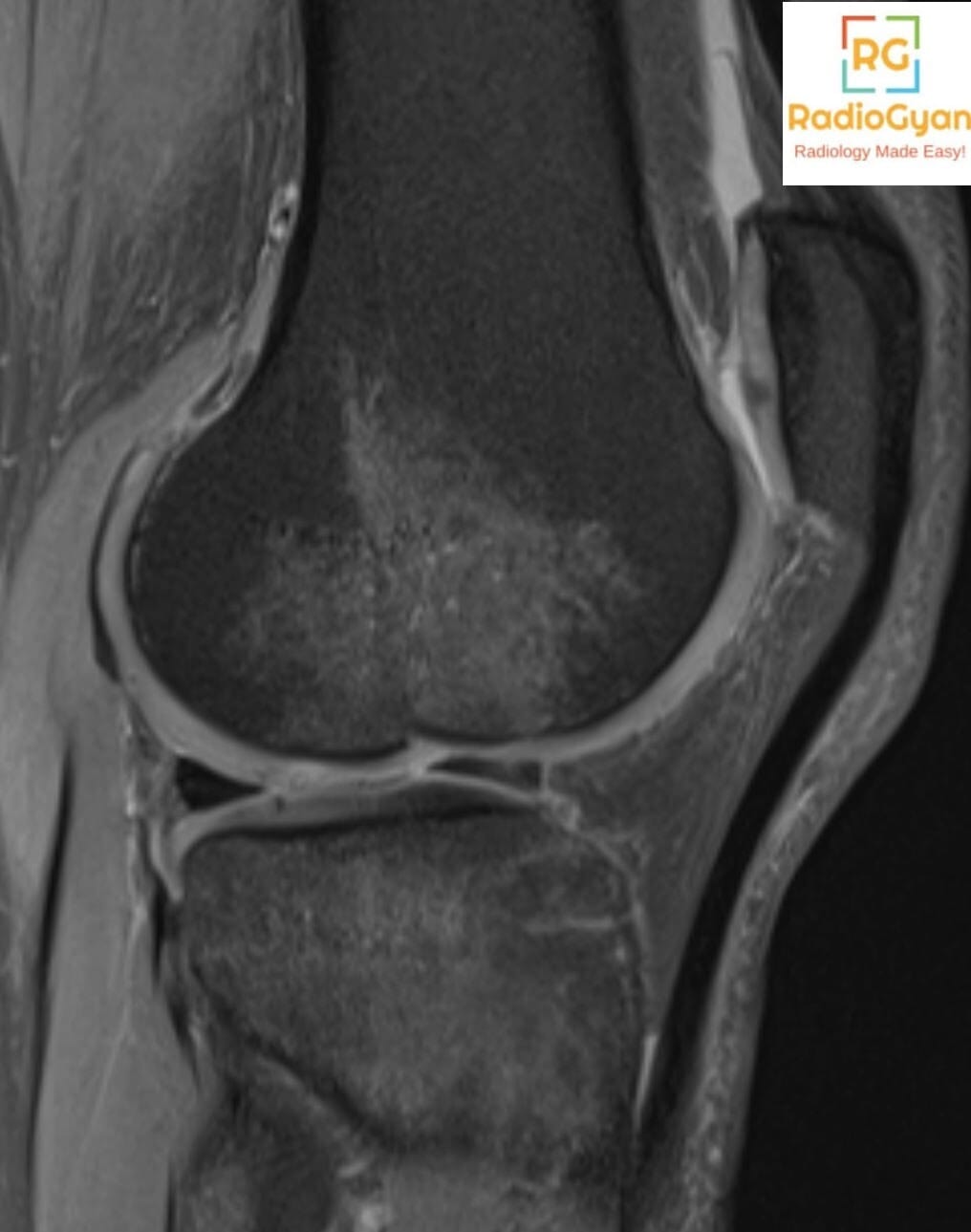 Lateral Femoral Notch Sign | Radiology Signs