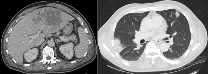 Liver Abscess with Pulmonary Septic Emboli | Radiology Case