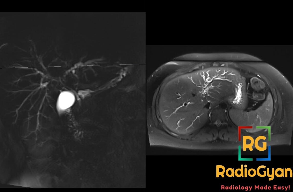 Primary Sclerosing Cholangitis Overview | Radiology Case