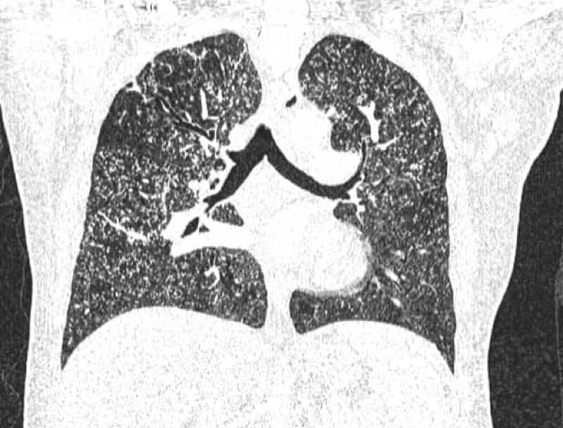 Miliary Tuberculosis | Radiology Case