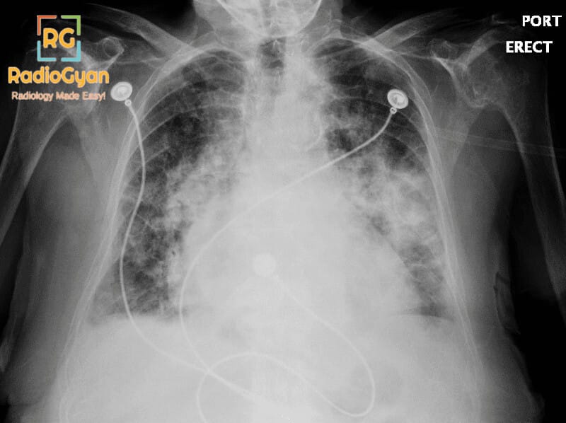 Bat-wing Appearance | Radiology Signs